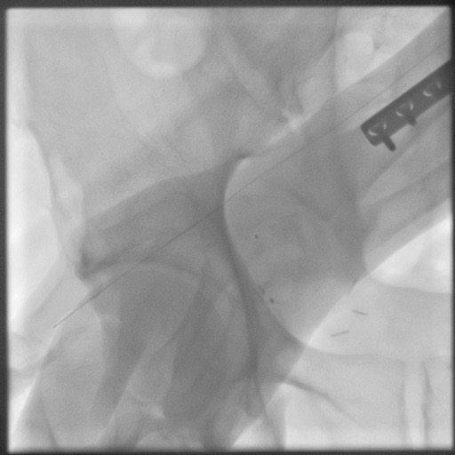 Use - Distal Radial Access Wrist Support - DRAWS